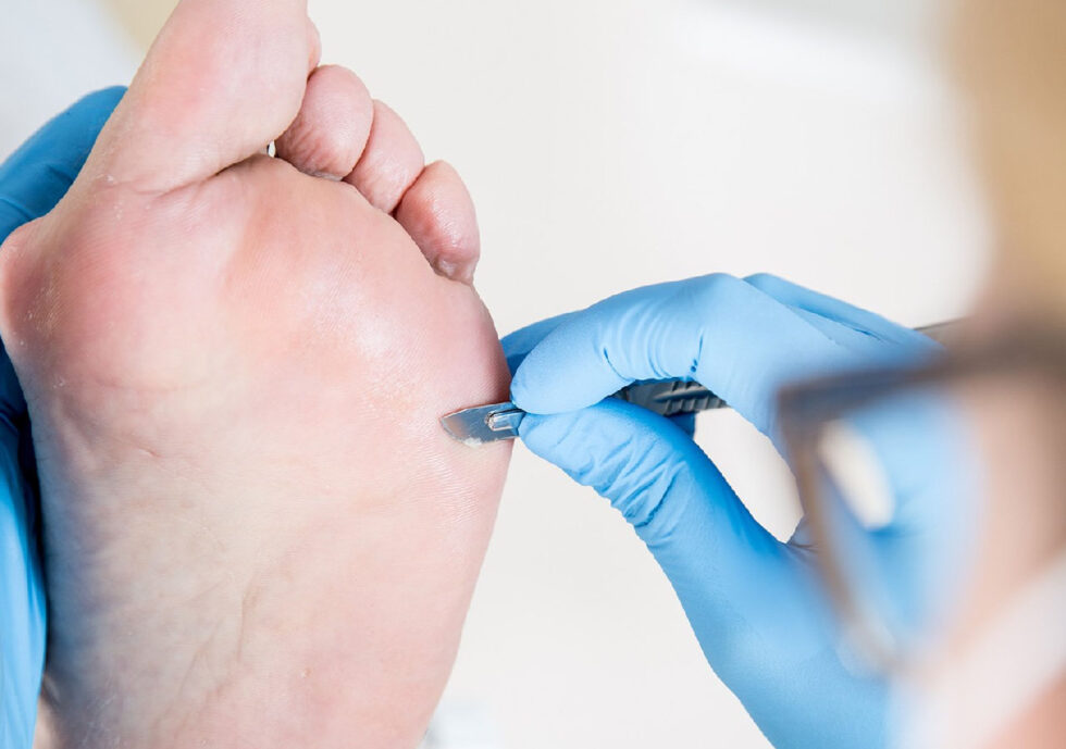 Hiperqueratosis - Podólogos Pie Picazza